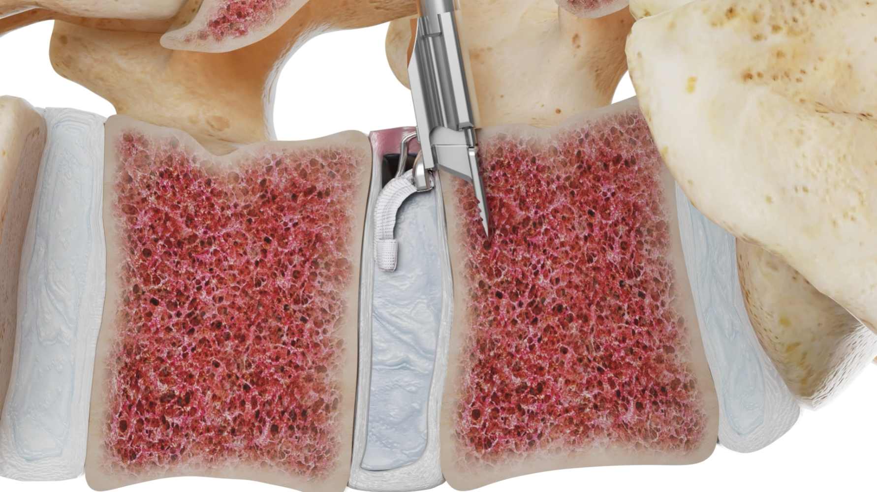 Revolutionizing Herniated Disc Surgery | Barricaid